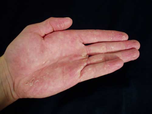Hyperhidrosis Induced Hand Peeling
